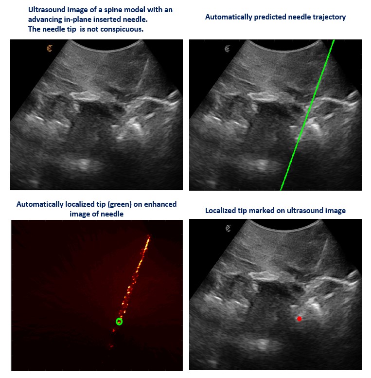 Machine Learning Algorithms to Improve Needle Localization in ...